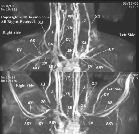 3D Brachial Plexus MRI/MRA/MRV: 2D TOF MRA/MRV Coronal 3D Image (Neutral and AER positions)