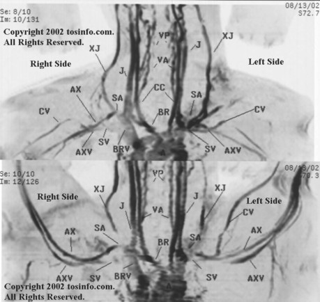 3D Brachial Plexus MRI/MRA/MRV: 2D TOF MRA/MRV Coronal 3D Image ...