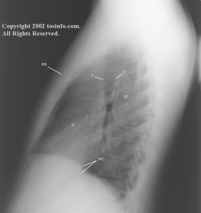 3D Brachial Plexus MRI/MRA/MRV: Lateral Chest Radiograph